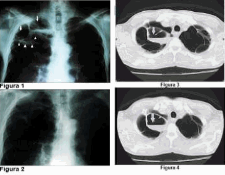 cristiano Laboratorio Ciudadano bulla pulmonar tac Prestado camarera ...